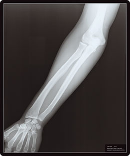 Esculapio Hijo del Sol: Radio y Cúbito