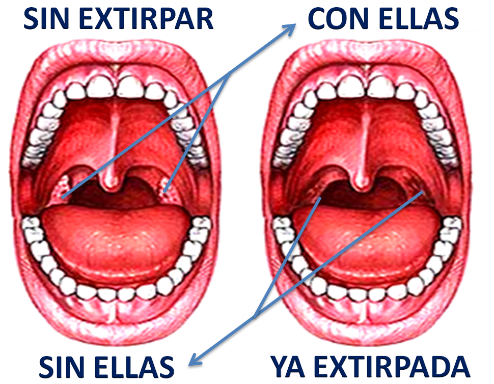 ¿QUÉ ES LA AMIGDALECTOMÍA? - Enciclopedia de Tareas