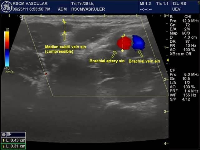 Spesialis Bedah Vaskular dan Endovaskular: Prosedur : Cimino, AV ...