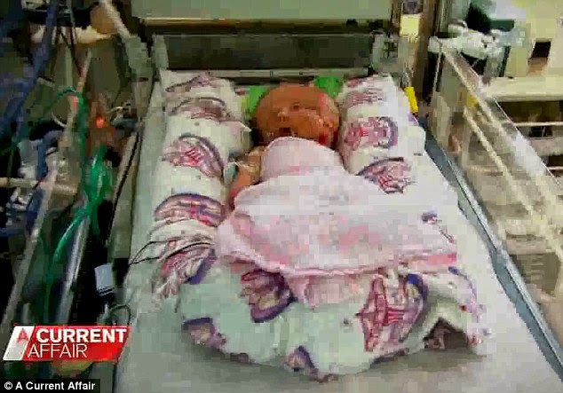 THE BABY WITH TWO FACES: AUSTRALIAN MOTHER-OF-SEVEN GIVES BIRTH TO ...