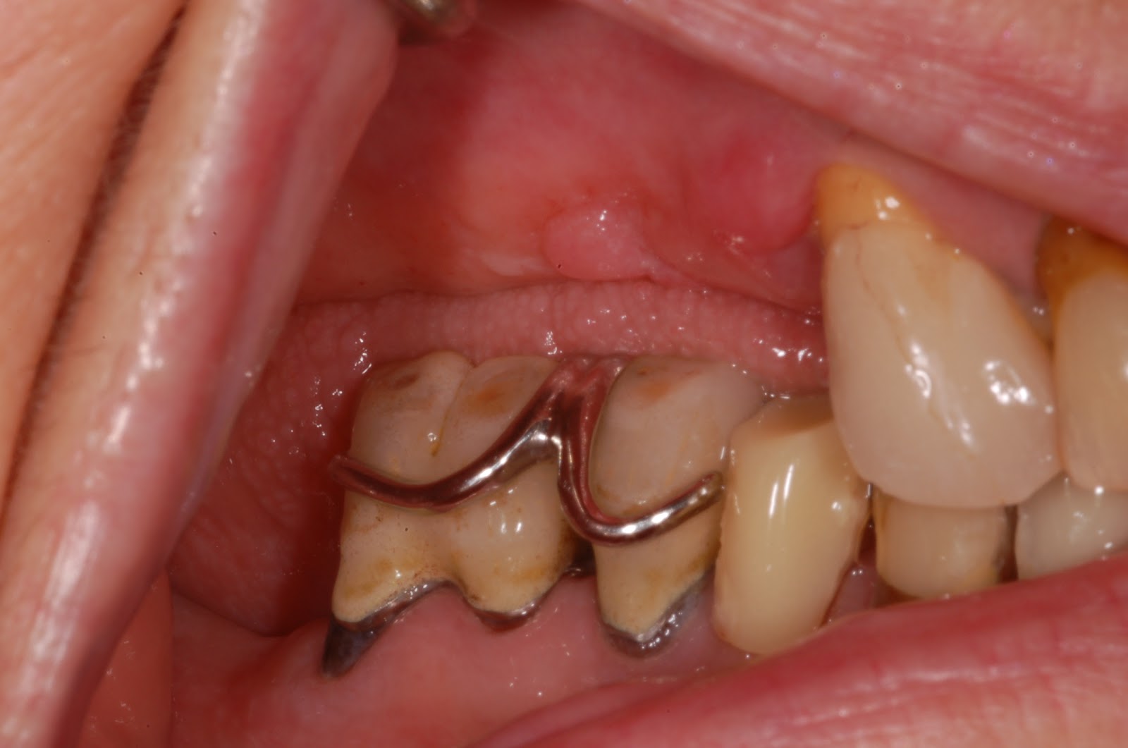 Implant Supported Bar Overdenture parts and cost - Bauer Smiles
