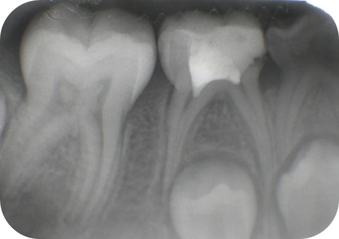 Odontopediatría: Terapia Pulpar en Dientes Deciduos
