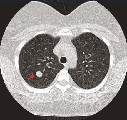 ESPE 203-2013: Caso clínico: Nódulo Pulmonar Solitario