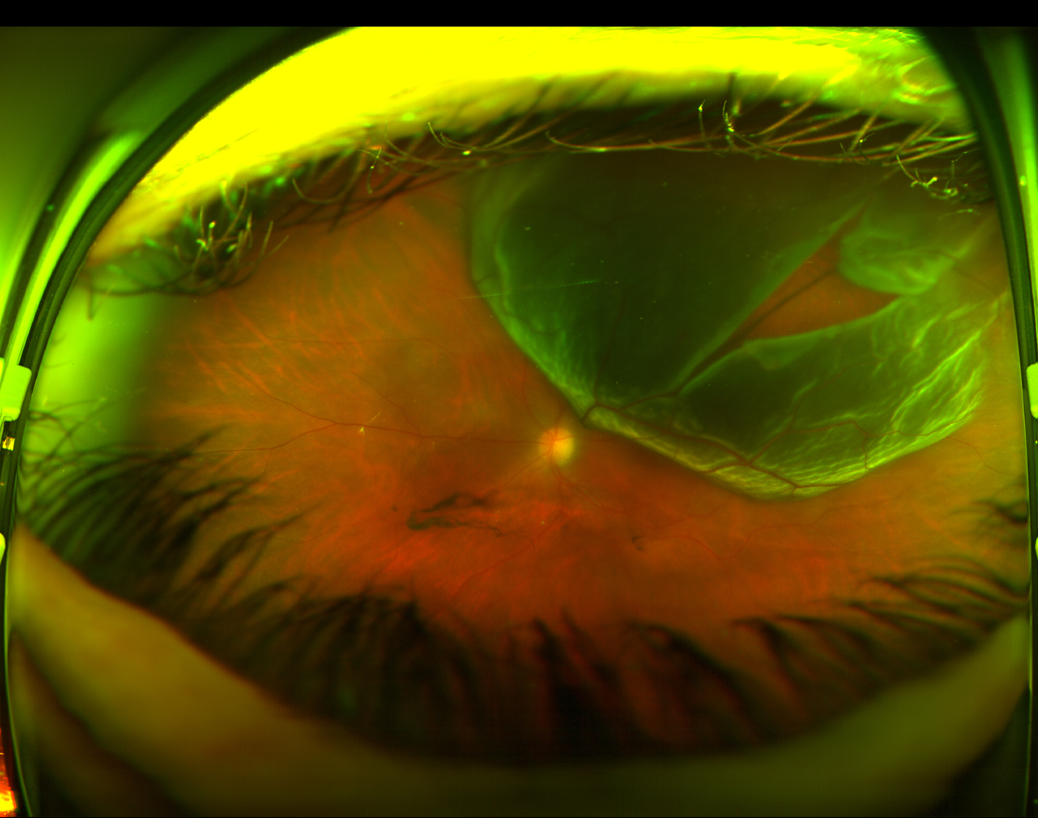 What The Fundus? New Website for Sharing Optos Retinal Images - Eyedolatry