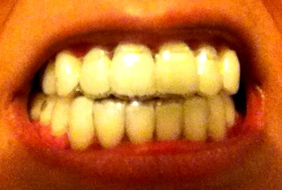 Invisalign For Severe Anterior Open Bite - My Pictures and Story: Set ...