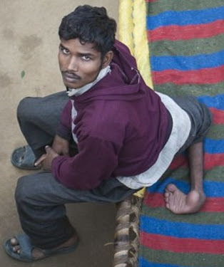 Photos: Indian Man Born With 4 Legs Begs Doctors To Amputate Extra ...