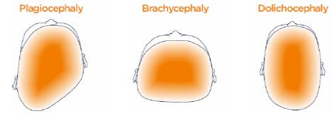 New Born Baby: Flat Head Syndrome