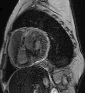 Delayed Enhancement-Cardiac MRI - Sumer's Radiology Blog