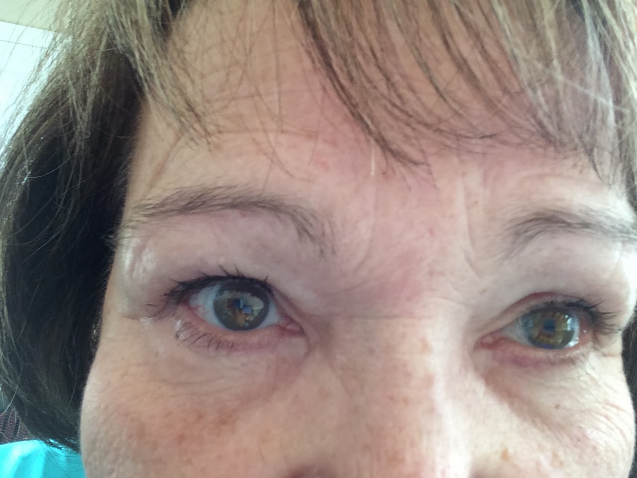 Tear Duct Surgery - DACRYOCYSTORHYNOSTOMY (DCR): 2013