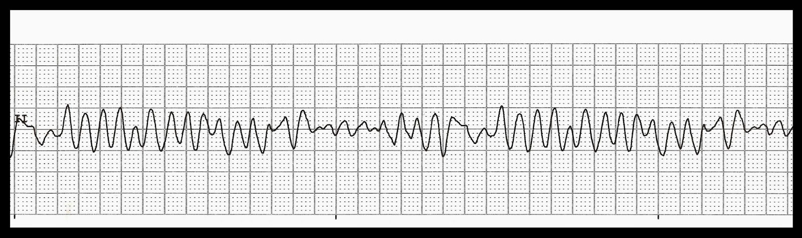 Basic EKG Rhythm Test 20