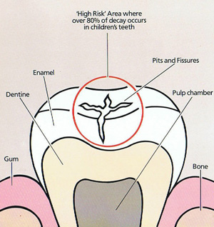 FAMILY CARE DENTAL: FISSURE SEALANTS