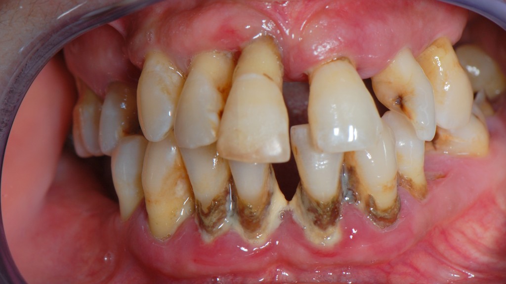 INFECCIONES BUCALES: PERIODONTITIS