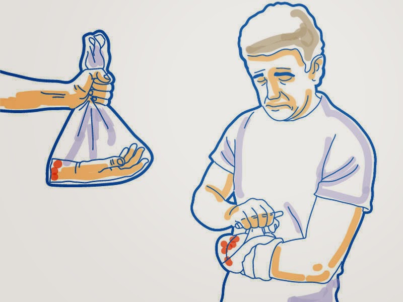 Primeros Auxilios: Manejo de amputaciones