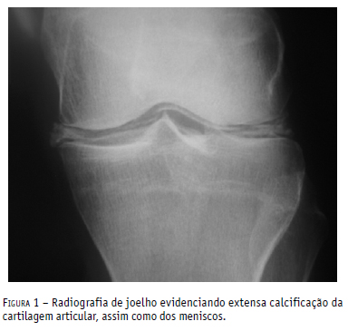 Condrocalcinose articular familiar