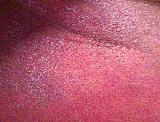 Hepatitis C-Managing Adverse Effects and Complications in Completing ...