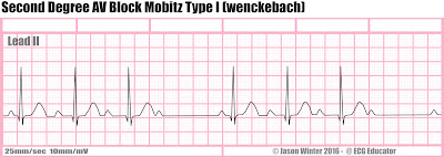 ECG Educator Blog : Second Degree AV Block Mobitz Type I (wenckebach)