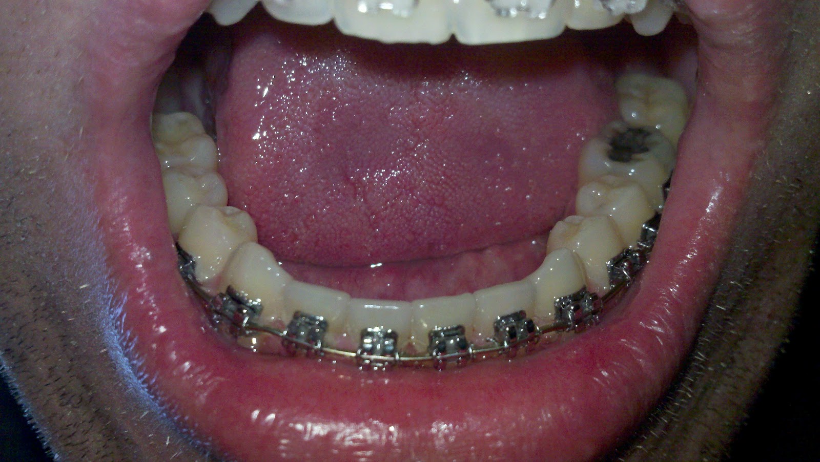 Braces/Open Bite Surgery: FINALLY Sure Smile Wires are in!