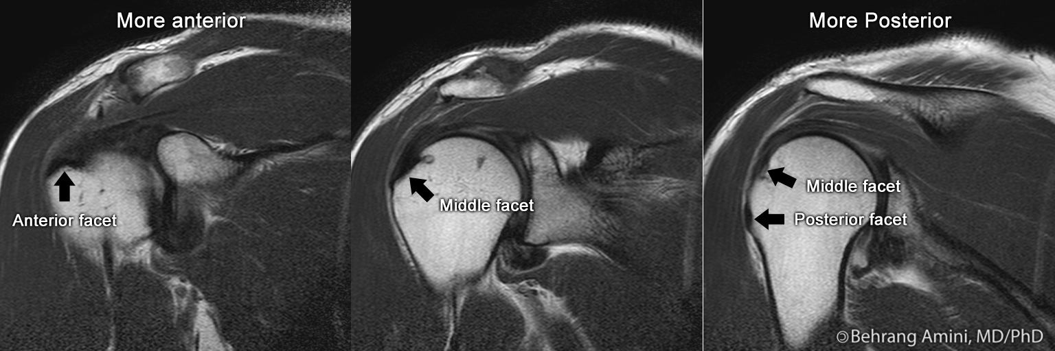 Roentgen Ray Reader: Facet Anatomy of the Greater Tuberosity
