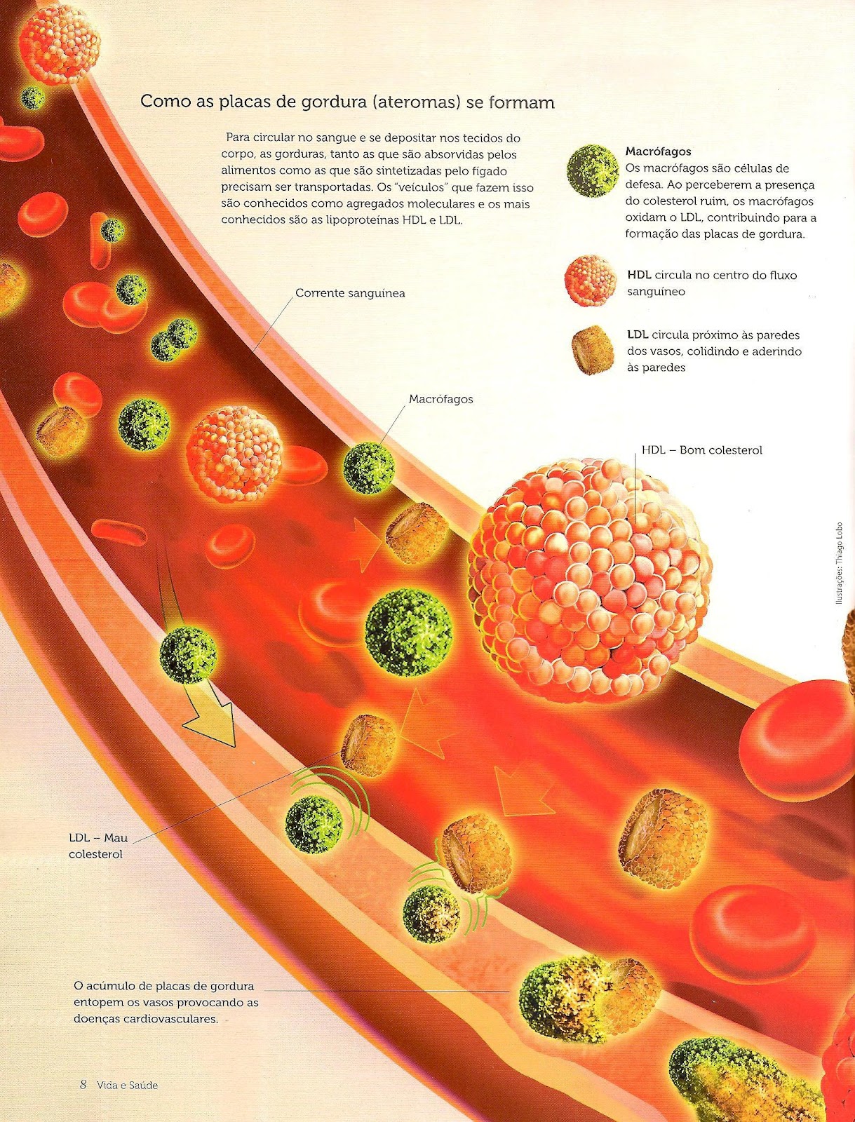 Medical do Brasil: Como as placas de gordura (ateromas) se formam?