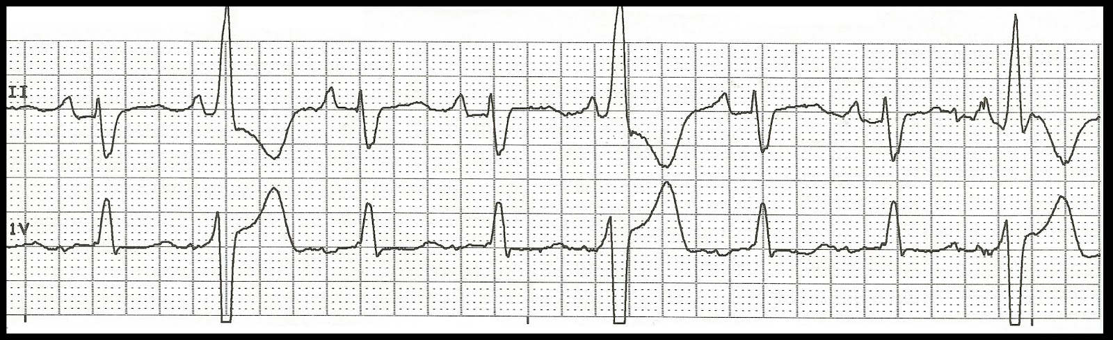 Practice EKG Rhythm Strips 175