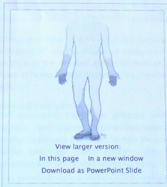 "Small Fiber Neuropathy"
