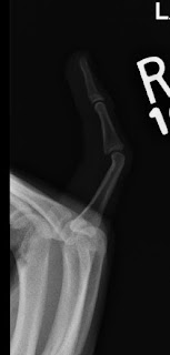 Mild Camptodactyly | Congenital Hand and Arm Differences | Washington ...