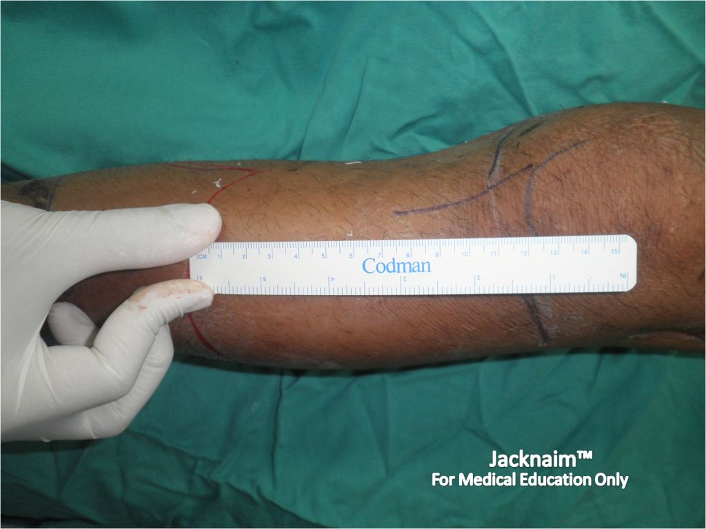 My Medical Notes: The Burgess Long Posterior Flap Below Knee Amputation