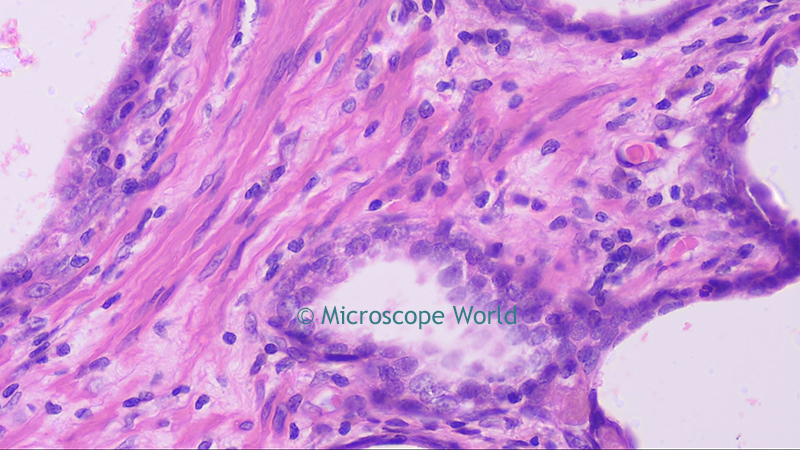Microscope World Blog: Prostate Cancer under the Microscope