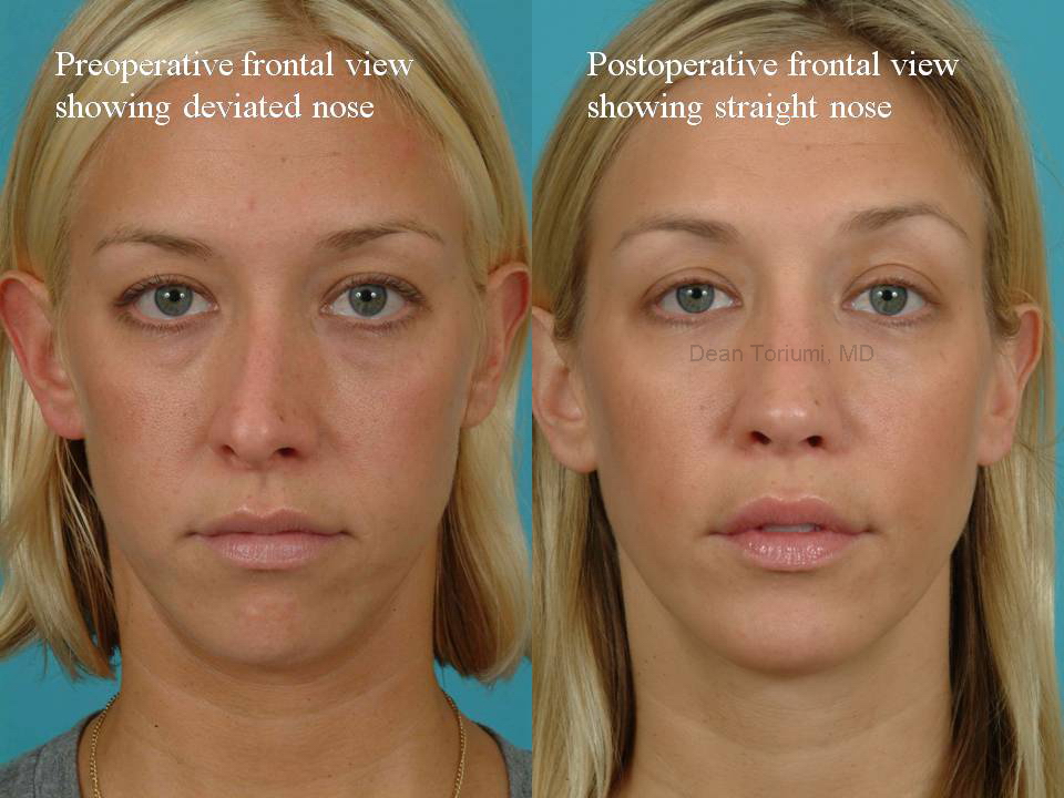 Dr. Dean Toriumi Reviews: Dean Toriumi Reviews: Crooked nose and Nasal ...