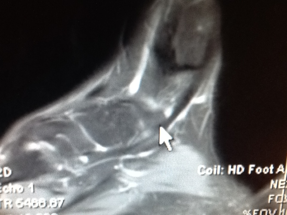 Foot and Ankle Problems By Dr. Richard Blake: Images for Os Navicularis ...
