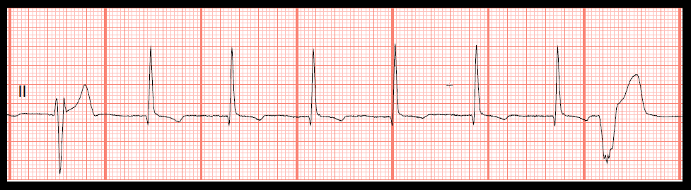 Various Accelerated Junctional Rhythms