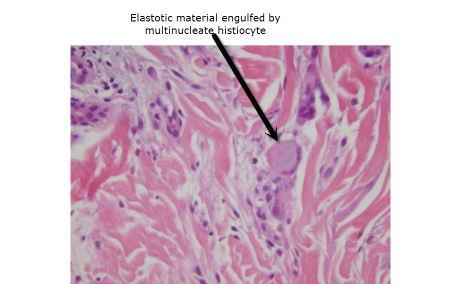 Dermatopathology Made Simple - Inflammatory: Granulomatous Reaction Pattern