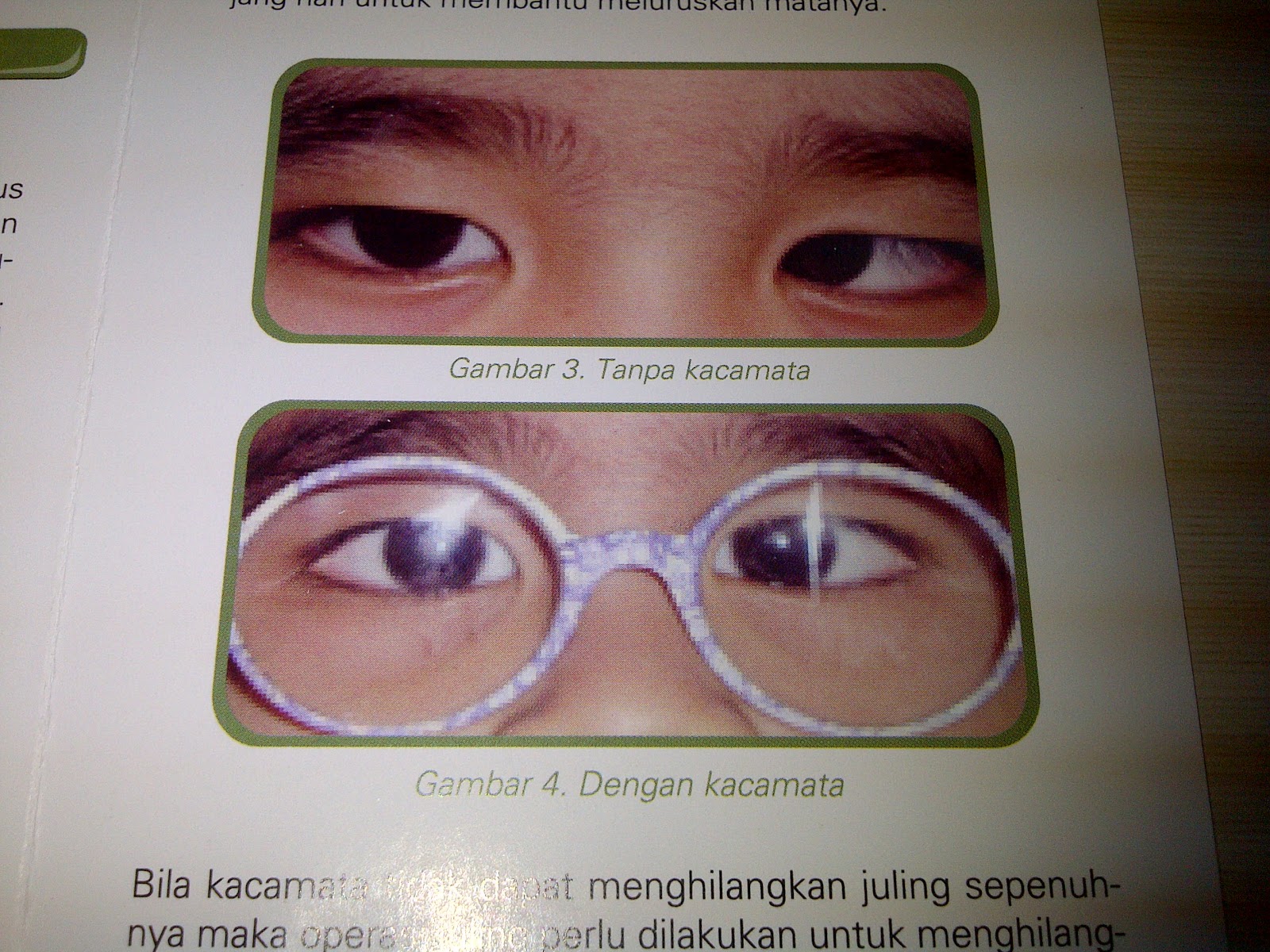 Me...and My Daily Life....: Strabismus dan Ambliopia (Lazy Eye) >> Part 1