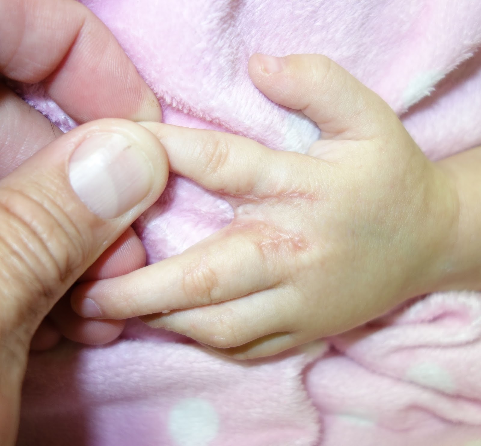 Partial Syndactyly | Congenital Hand and Arm Differences | Washington ...