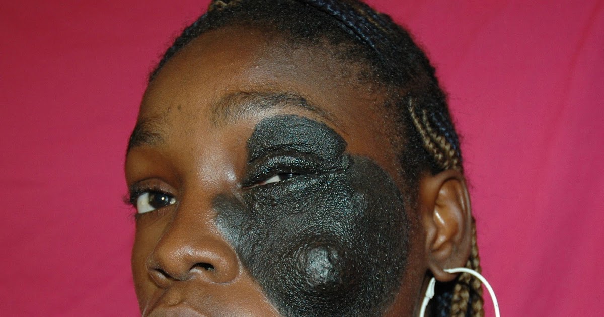 Earthwide Surgical Foundation: GIANT HAIRY NEVUS