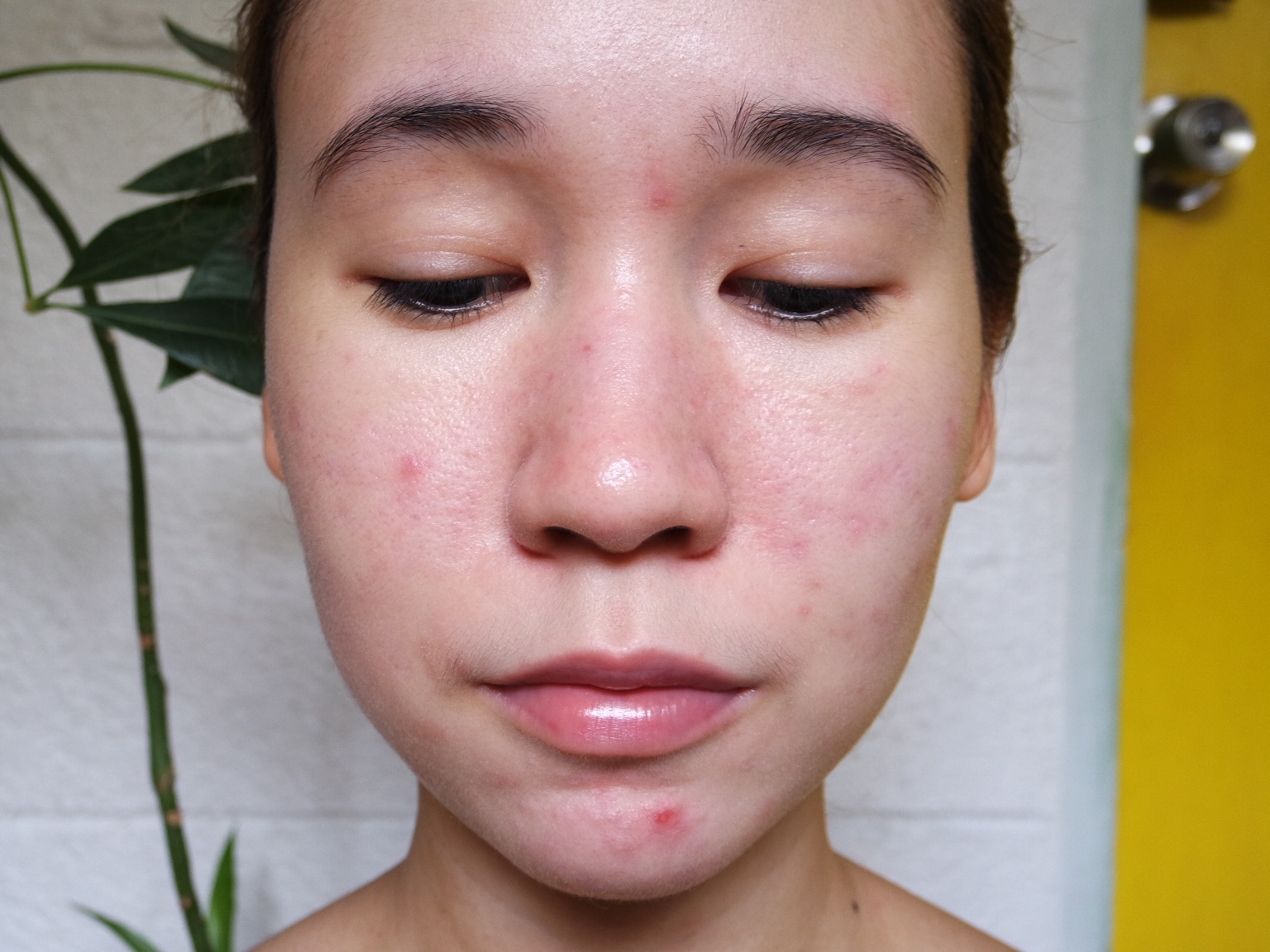My ISOTRETINOIN JOURNEY (ACNOTIN/ACCUTANE) 6 MONTHS SKIN UPDATE