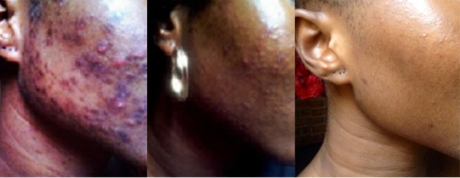 Stretch Marks, Pimples, Acne etc