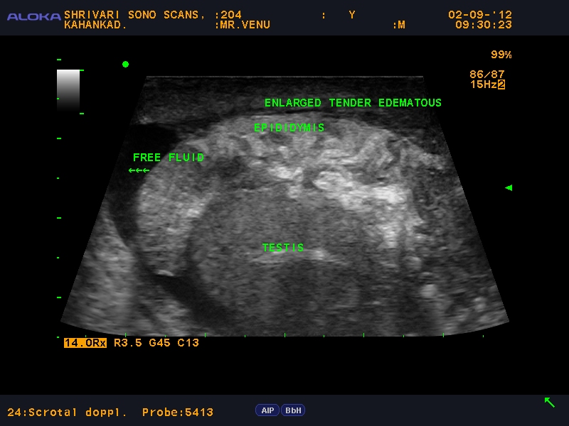 Shrivari Sono Scans: Hrsg imaging scrotum-Images of epididymis in Acute ...