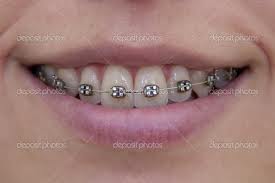 NUESTRO BLOG ROSA: LOS BRACKETS