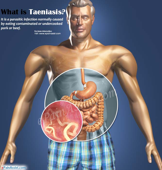 Obat Herbal Taeniasis Paling Ampuh Tanpa Efek Samping