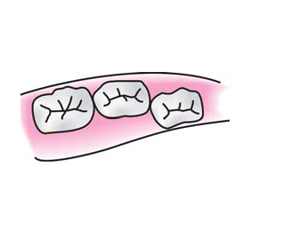 Classification of impacted mandibular third molar