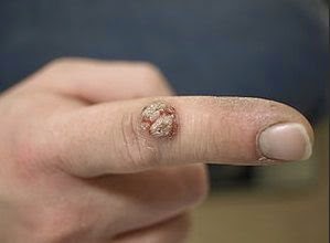 Obat Kutil Pada Kulit Herbal dan Kimia Yang Ampuh dan Mujarab - Obat Sehat