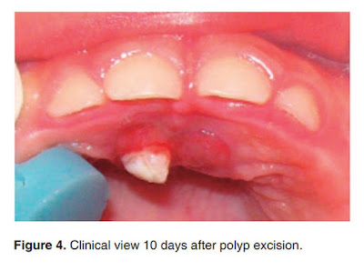 PDF: Supernumerary teeth in primary dentition associated to palatal ...