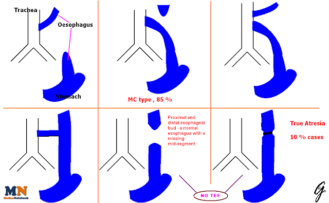 MedicoNotebook: Tracheoesophageal fistula