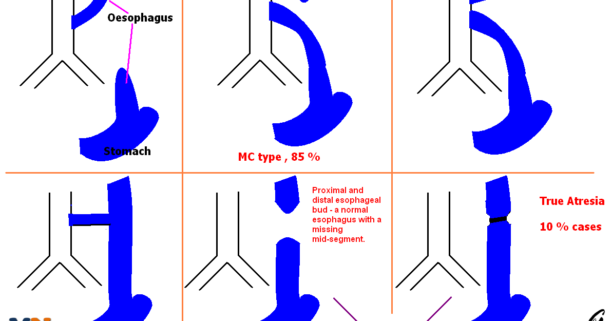 MedicoNotebook: Tracheoesophageal fistula
