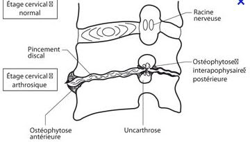 Uncodiscarthrose cervicale c5 c6 - Danielle Bucklin