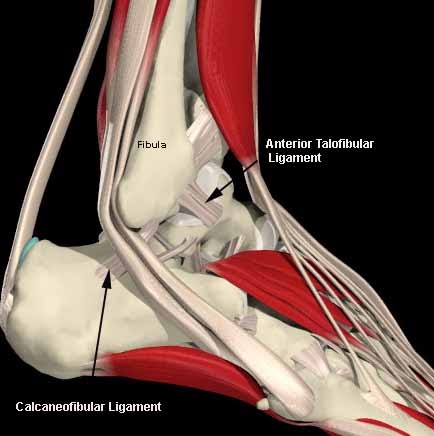 Avulsion fracture of the talar attachment of the anterior talofibular ...