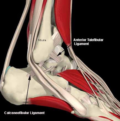 Avulsion fracture of the talar attachment of the anterior talofibular ...