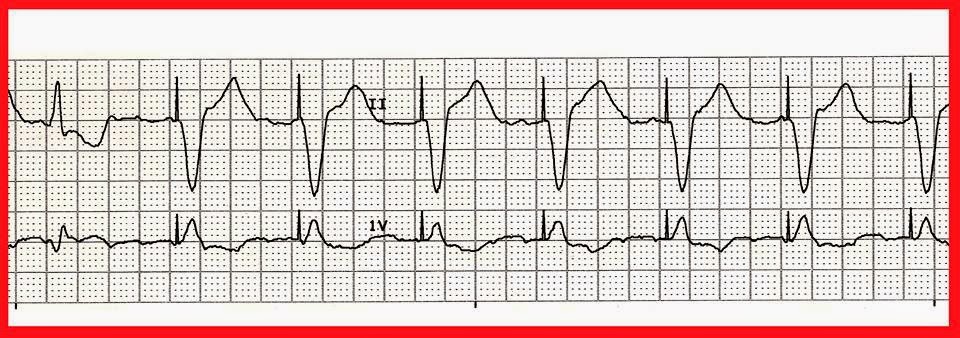 Practice Rhythm Strips 302