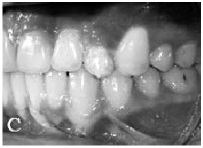 Ilmu Kedokteran Gigi: Kelainan pada Pertumbuhan dan Perkembangan Gigi ...